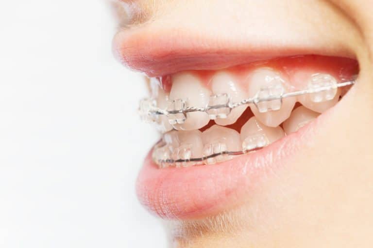 Orthodontics Options: 4 Most Common Types of Braces Brackets
