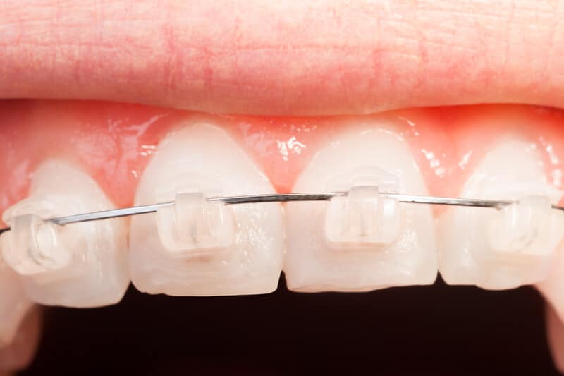 Portland Orthodontic Treatment: What is Ceramic Braces
